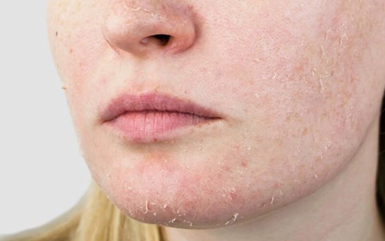 5 Common Winter Skin Problems & Ayurvedic Solutions | Charakveda